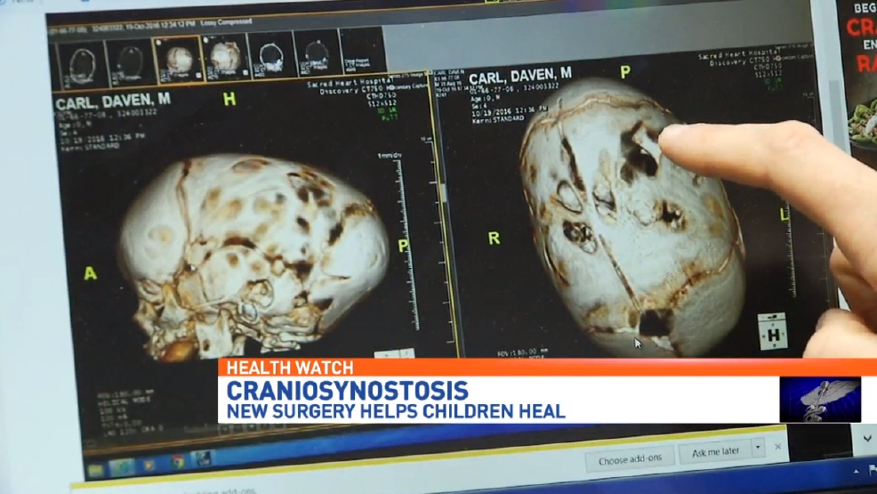 New, noninvasive surgery helps children with fused skull condition heal ...
