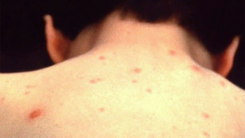 Chicken pox outbreak at Wash. school forces kids to stay home | KOMO